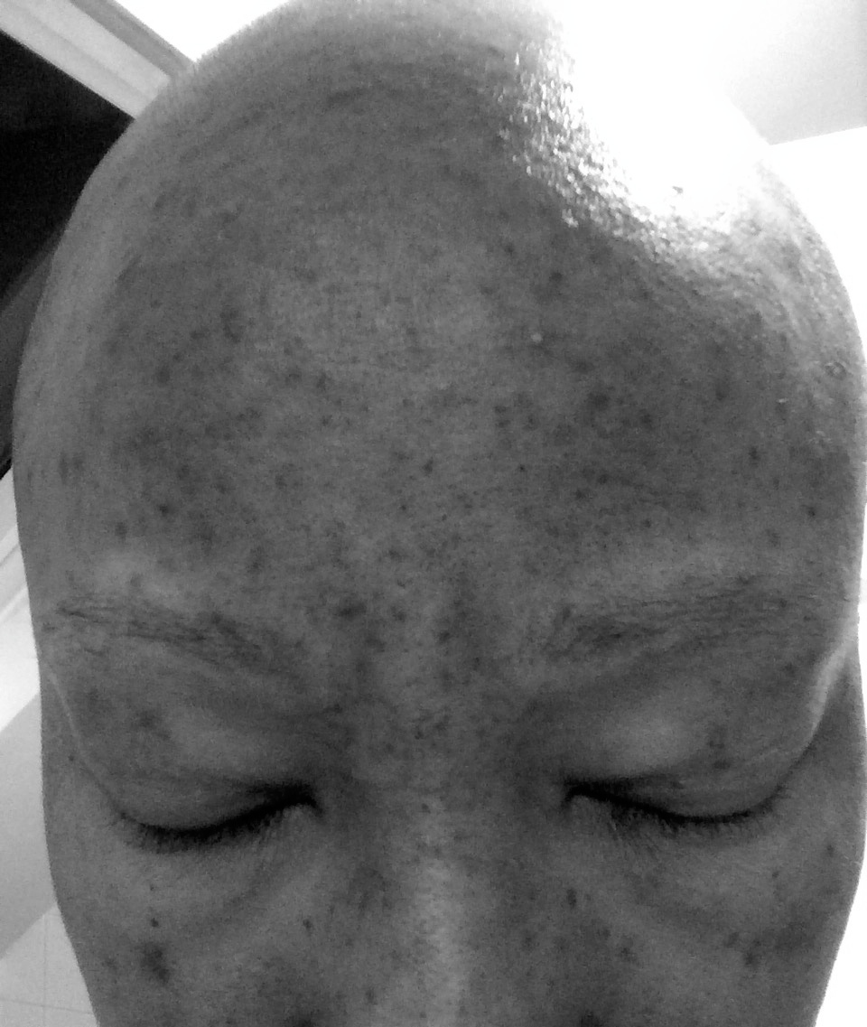 4. Chemo Side Effect The Second Time - rebeKemi